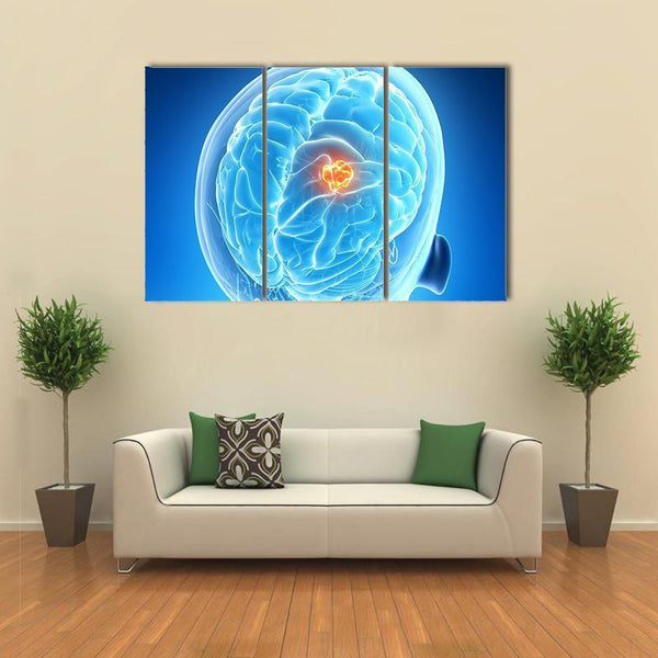 Glowing Brain Tumor Illustration Canvas Wall Art - Tiaracle